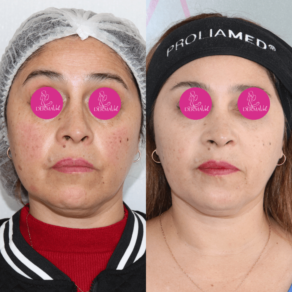 Fulloria | Dermaval